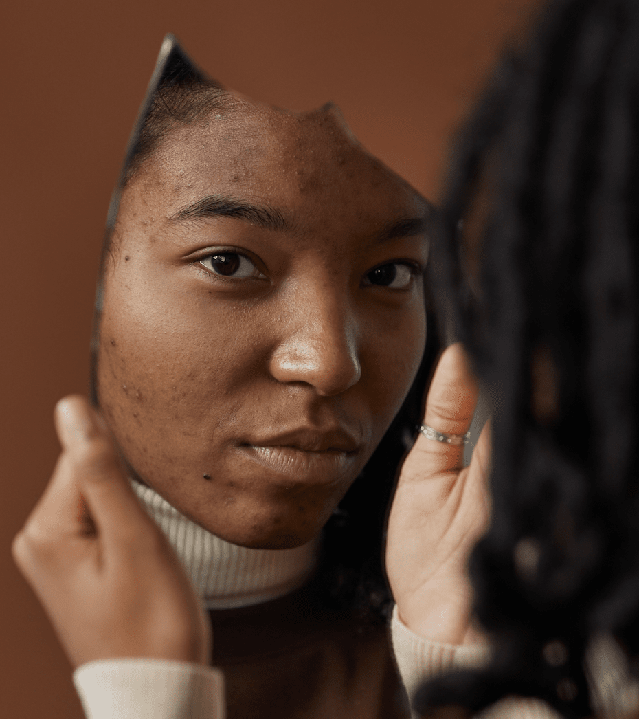 Acné : Comment venir à bout des tâches naturellement ? – Confort Global