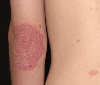 Comprendre les plaques de psoriasis : symptômes, causes et traitements ...